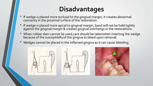 wedge and their technique and prewedging | PPTX | Oral care | Personal Care