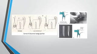 wedge and their technique and prewedging | PPTX