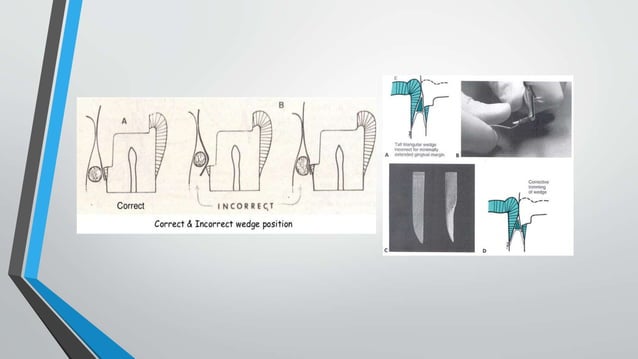 wedge and their technique and prewedging | PPTX | Oral care | Personal Care