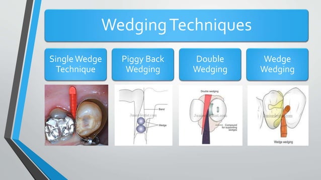 wedge and their technique and prewedging | PPTX | Oral care | Personal Care