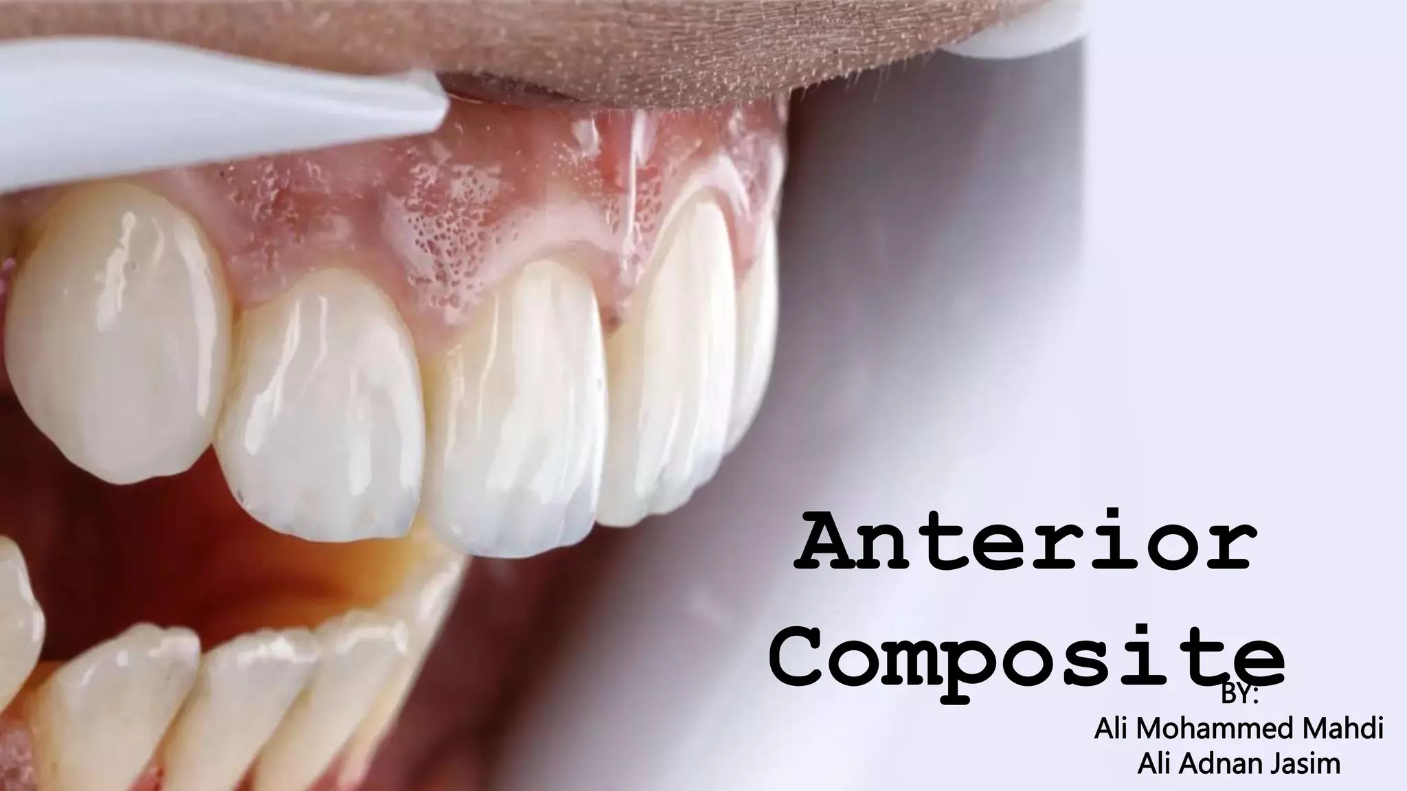 Anterior composite Dr. Ali Mohammed | PPTX