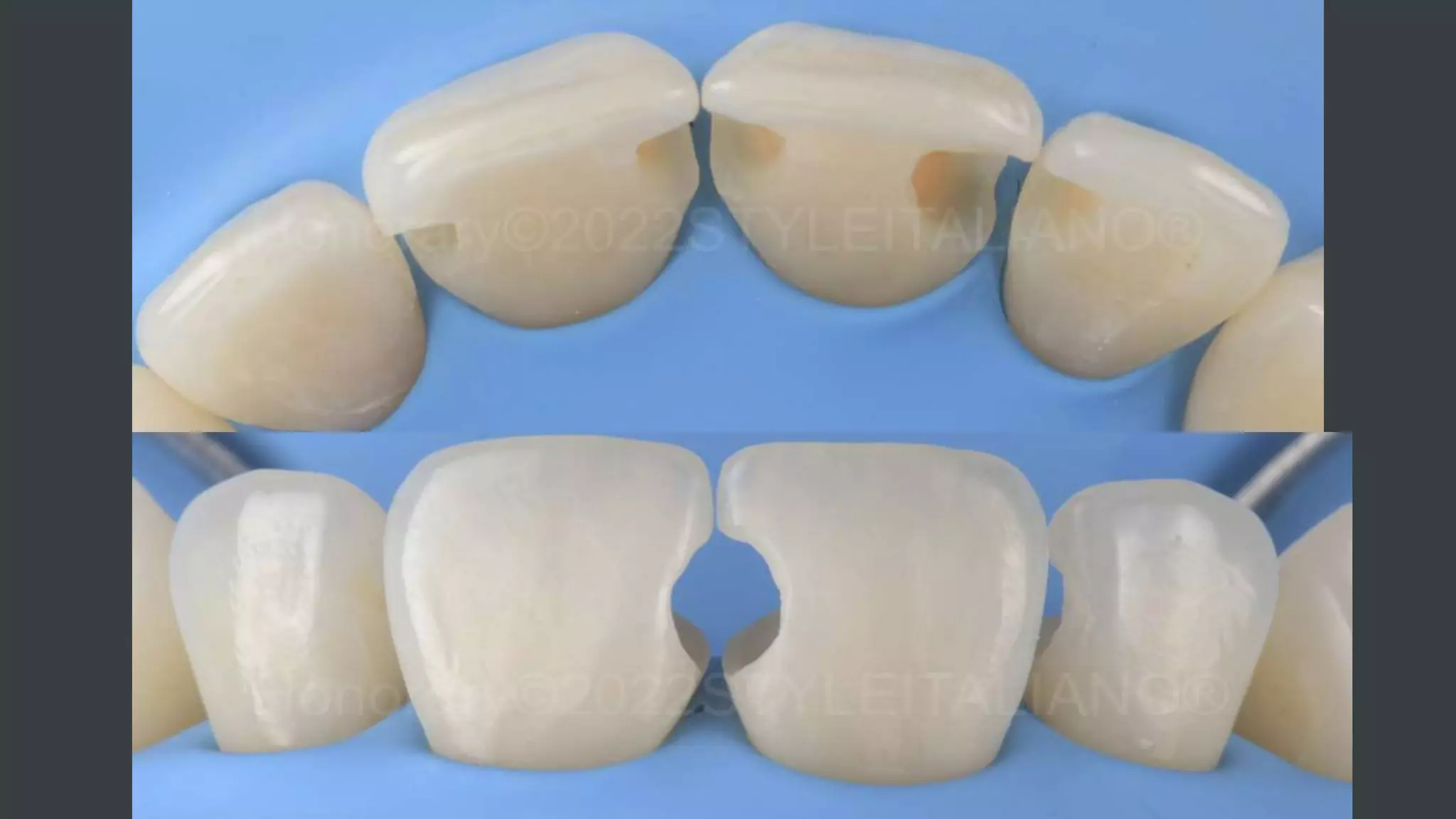 Anterior composite Dr. Ali Mohammed | PPTX