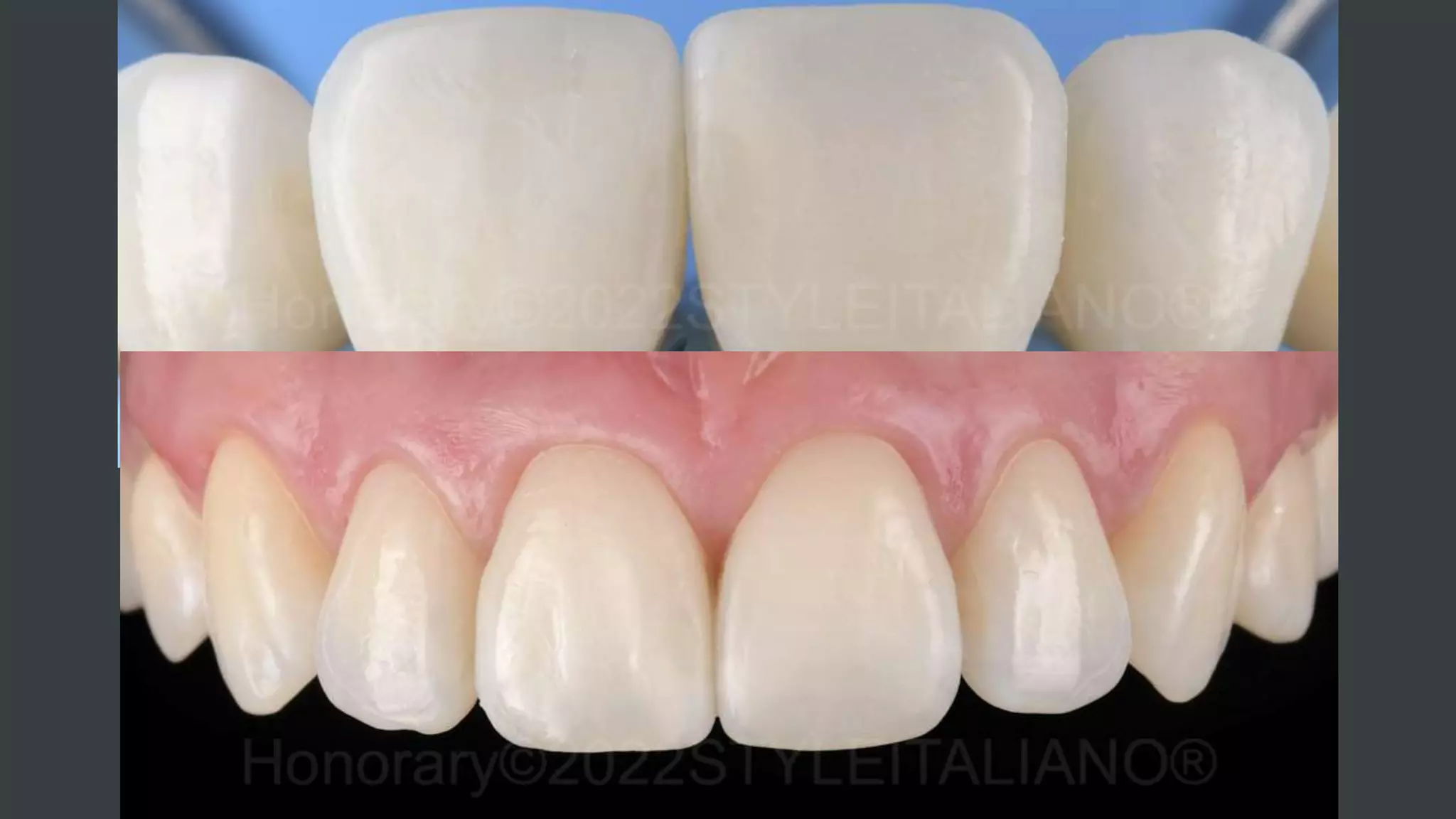 Anterior composite Dr. Ali Mohammed | PPTX