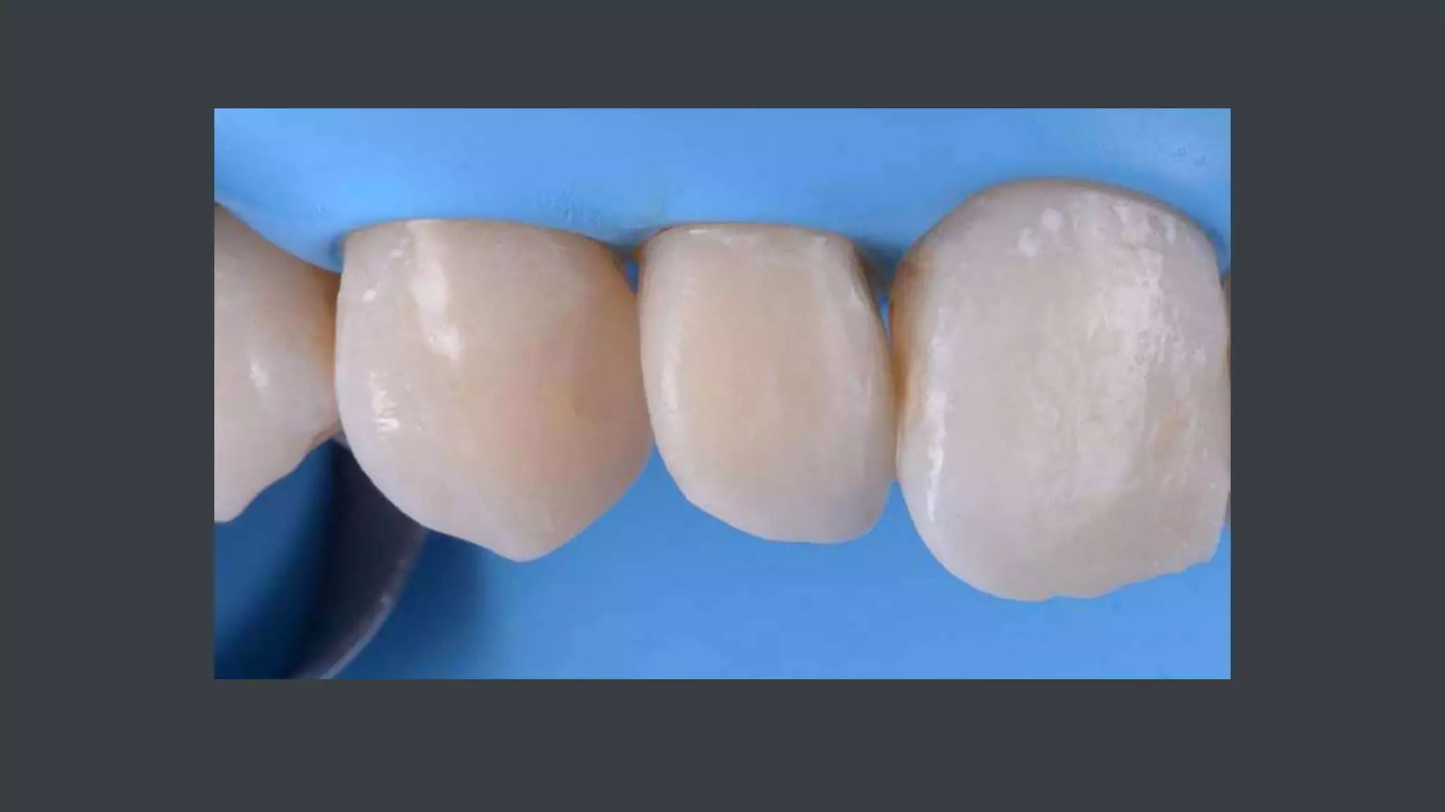 Anterior composite Dr. Ali Mohammed | PPTX