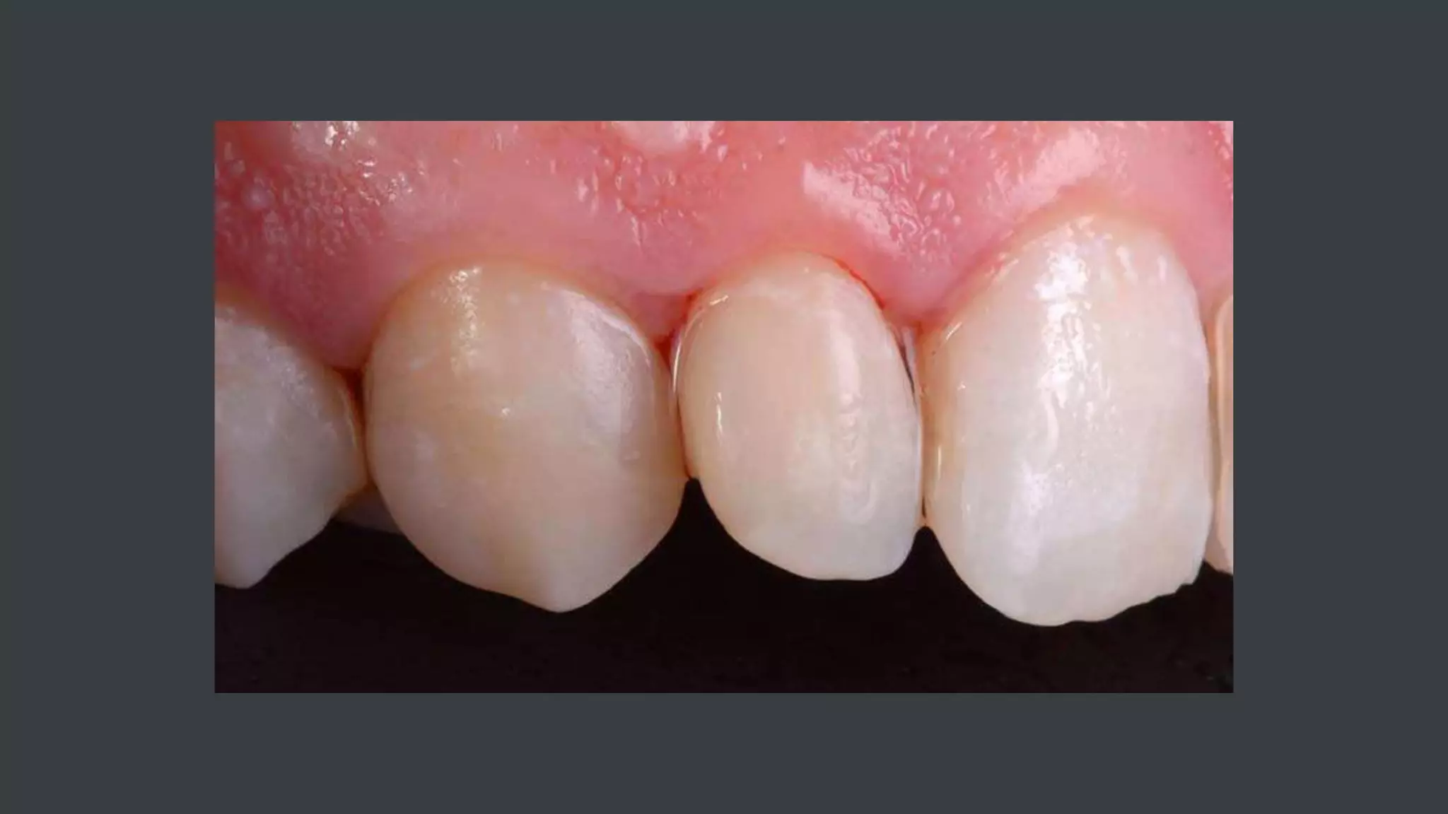 Anterior composite Dr. Ali Mohammed | PPTX