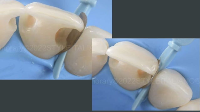 Anterior composite Dr. Ali Mohammed | PPTX