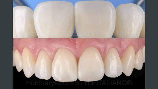 Anterior composite Dr. Ali Mohammed | PPTX