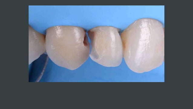 Anterior composite Dr. Ali Mohammed | PPTX