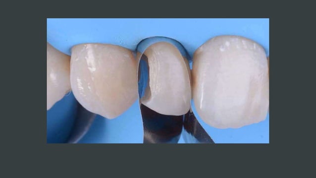 Anterior composite Dr. Ali Mohammed | PPTX