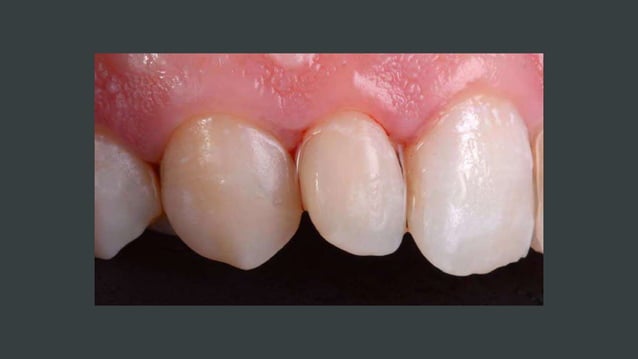 Anterior composite Dr. Ali Mohammed | PPTX