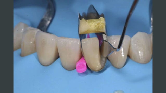 Anterior composite Dr. Ali Mohammed | PPTX