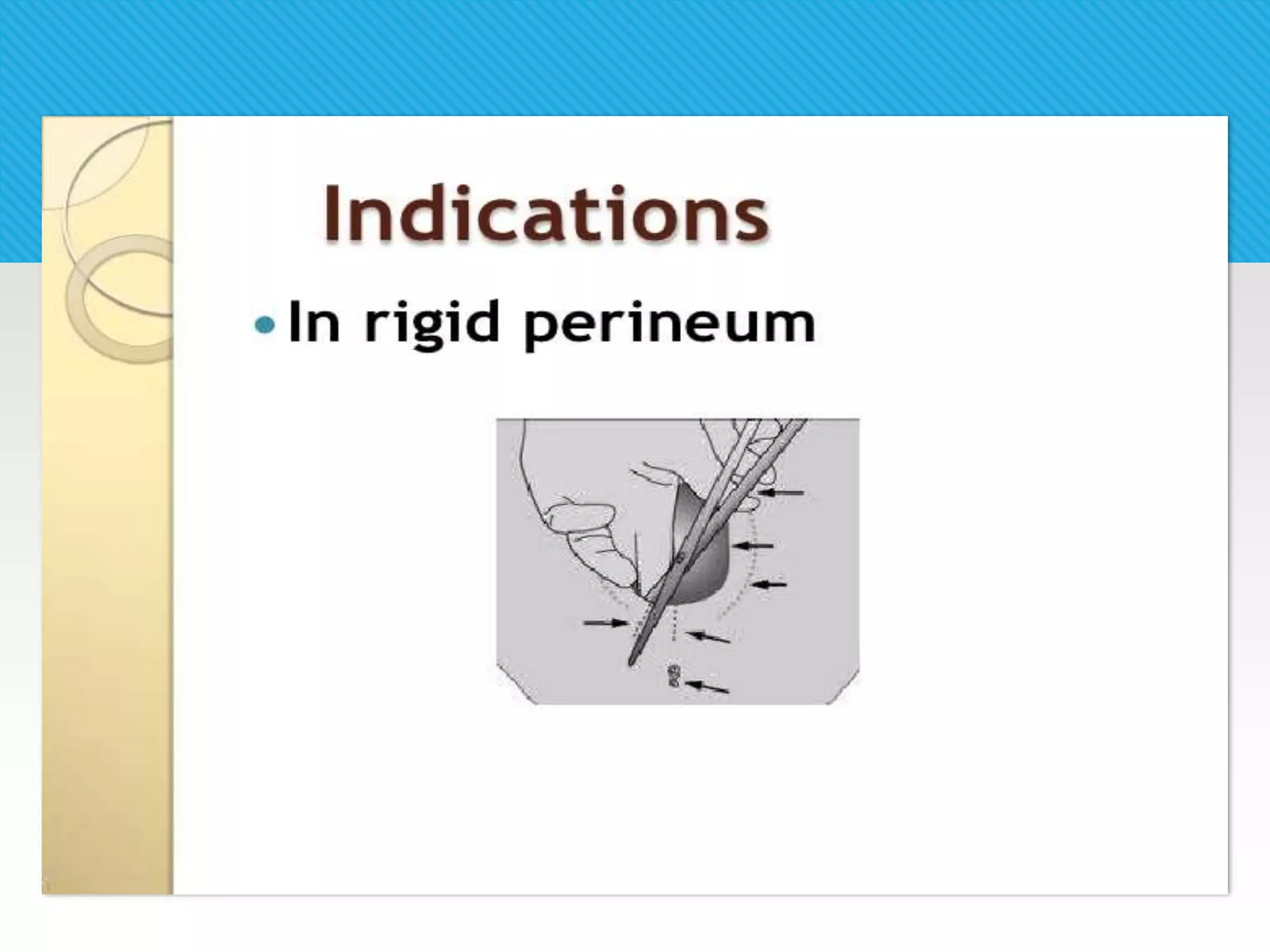Operative Vaginal delivery | PPTX