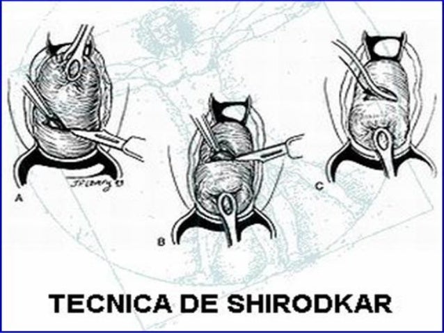 Operative gynecology