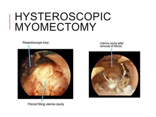 Operative hysteroscopy | PPT