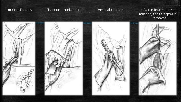 Operative Interventions In Obstetrics