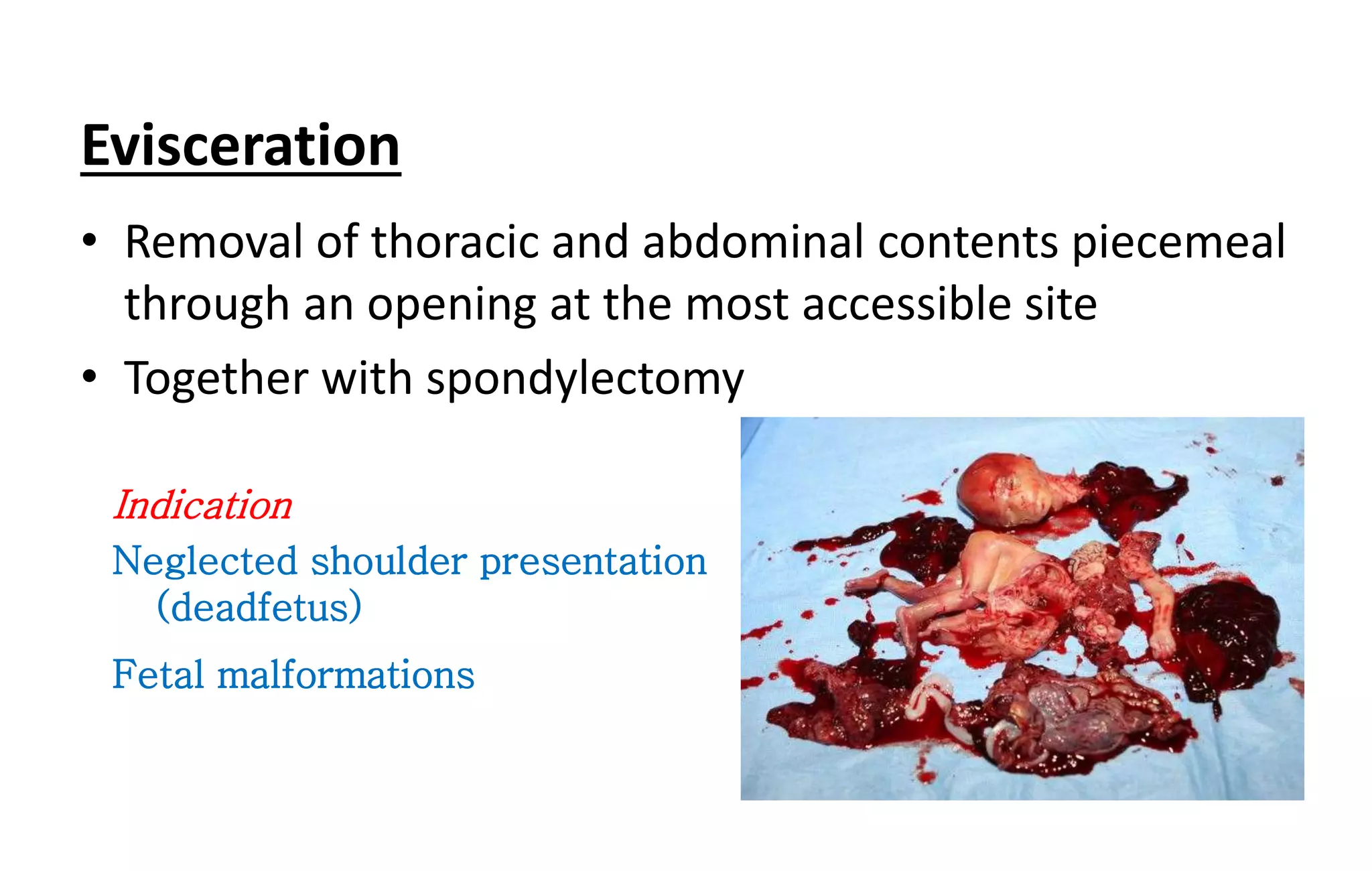 Operative procedure in obstetric | PPTX
