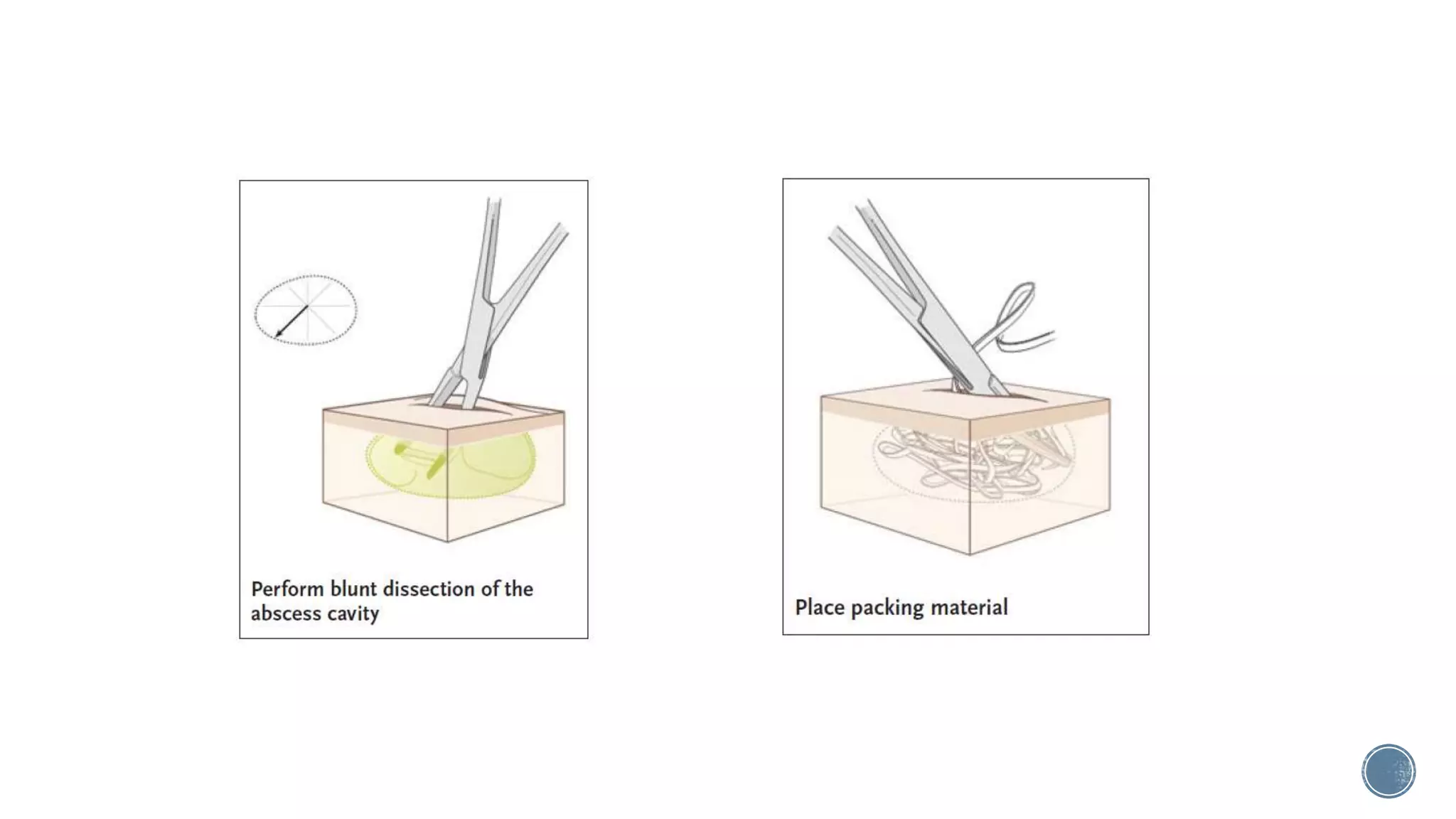 OPERATIVES #01 abscess, sebaceous_cyst & LN biopsy.pptx