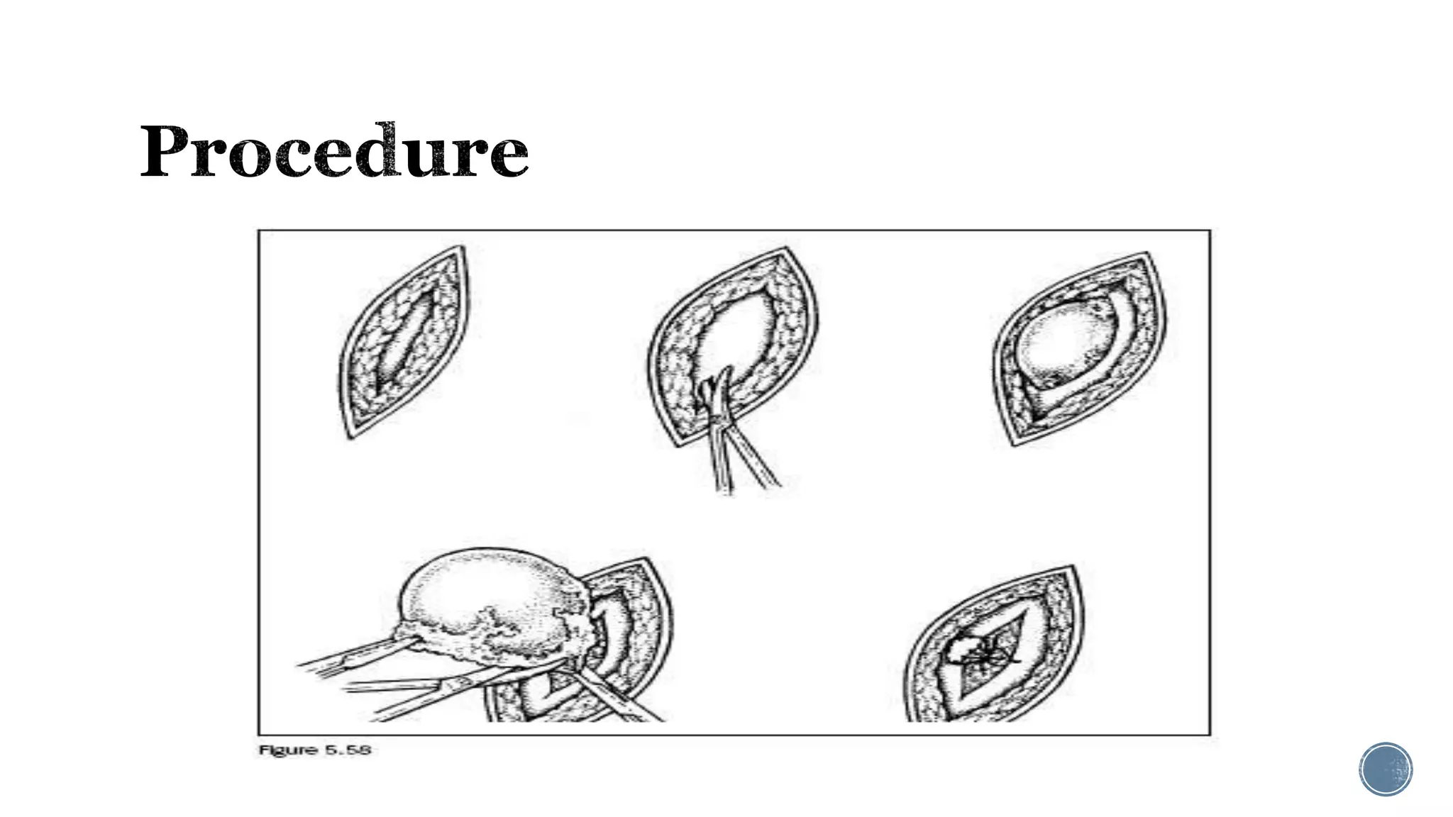 OPERATIVES #01 abscess, sebaceous_cyst & LN biopsy.pptx