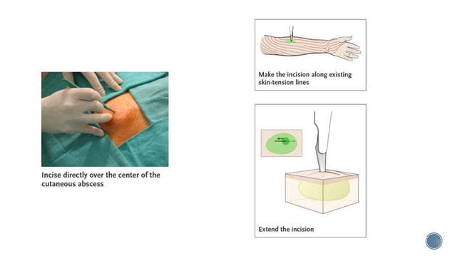 OPERATIVES #01 abscess, sebaceous_cyst & LN biopsy.pptx