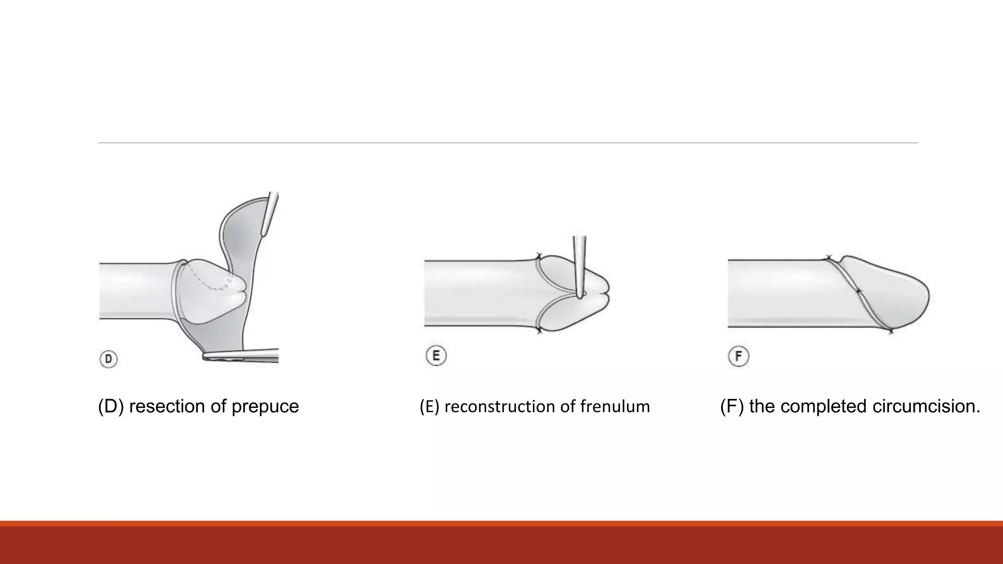 OPERATIVES #02 eversion of sac & circumcision.pptx