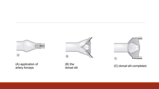 OPERATIVES #02 eversion of sac & circumcision.pptx
