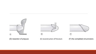 OPERATIVES #02 eversion of sac & circumcision.pptx