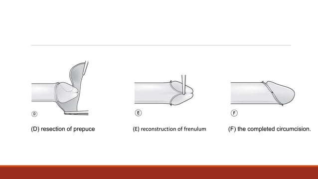OPERATIVES #02 eversion of sac & circumcision.pptx | Reproductive ...