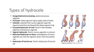 OPERATIVES #02 eversion of sac & circumcision.pptx