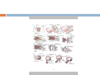 Operative steps in open appendicectomy | PPTX