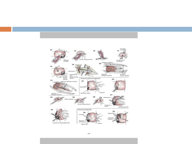 Operative steps in open appendicectomy | PPTX | Pregnancy ...