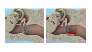 OPERATIVE SURGERIES of EAR.pptx