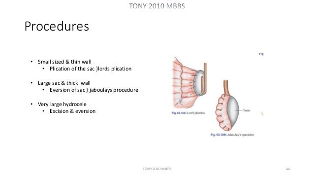 Operative surgery ppt mbbs students