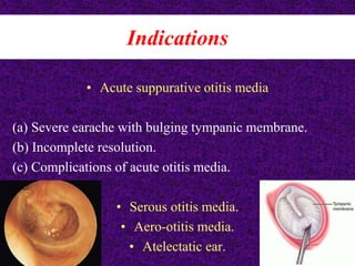 operative surgery in Ear, nose, throatNT.pptx