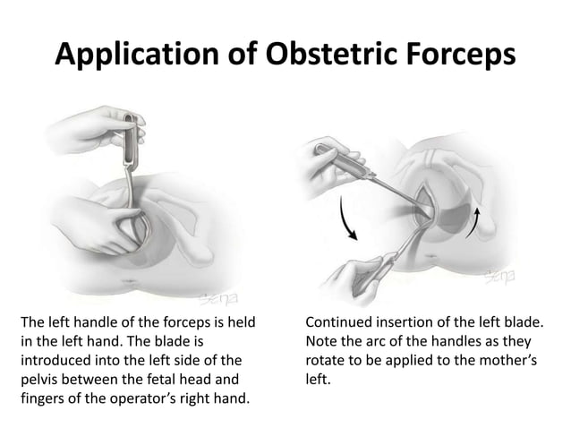Operative vaginal delivery | PPTX