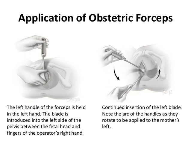Operative vaginal delivery