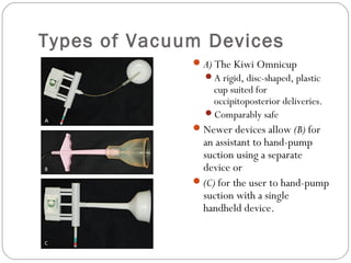Types Of Vacuum Delivery