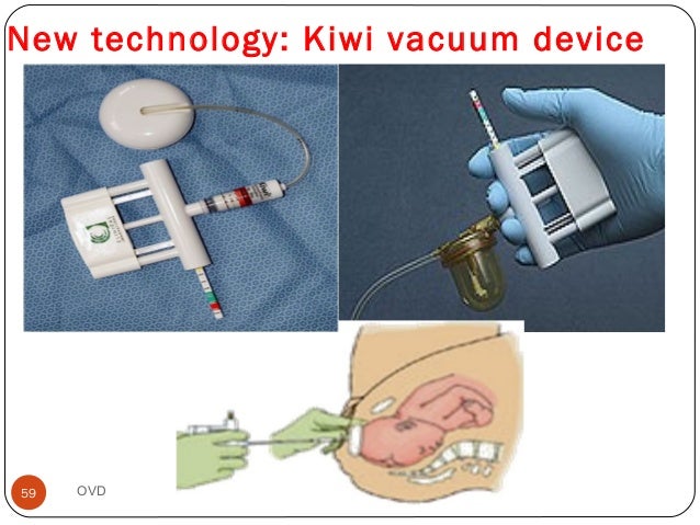 Operative vaginal delivery