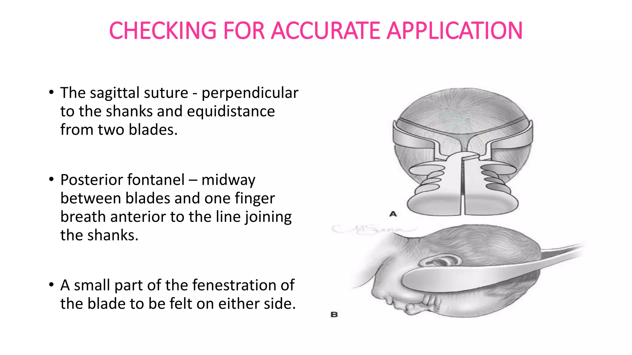 Operative vaginal delivery - forceps , vacuum delivery. | PPTX