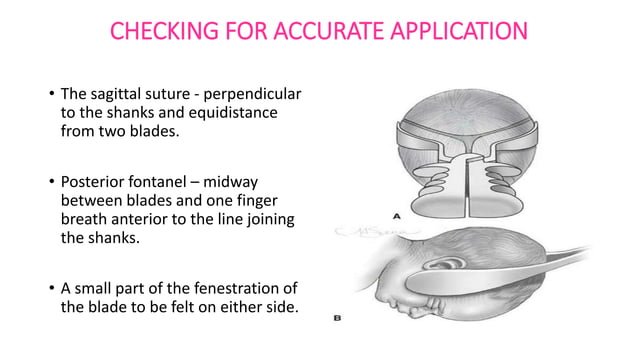 Operative vaginal delivery - forceps , vacuum delivery. | PPTX ...