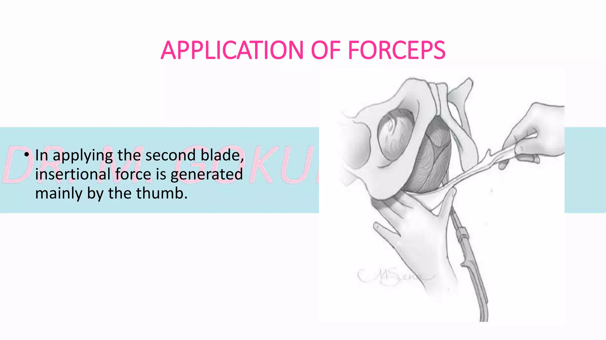 Operative vaginal delivery - forceps , vacuum delivery. | PPTX