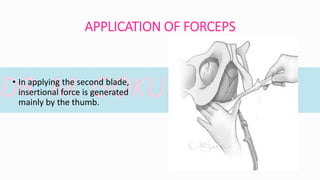 Operative vaginal delivery - forceps , vacuum delivery. | PPTX