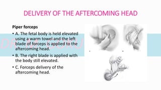 Operative vaginal delivery - forceps , vacuum delivery. | PPTX