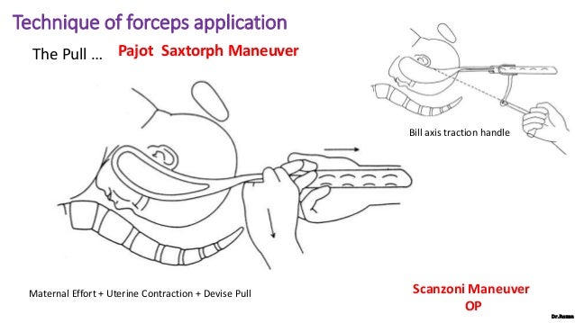 Operative Vaginal Delivery (Dr.Rozan)