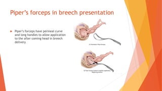 Operative Vaginal Delivery | PPT