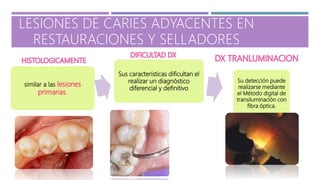 Operatoria -Deteccion de Caries Dental | PPTX