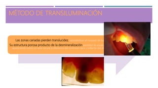 Operatoria -Deteccion de Caries Dental | PPTX
