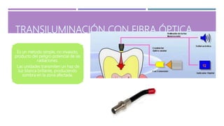 Operatoria -Deteccion de Caries Dental | PPTX