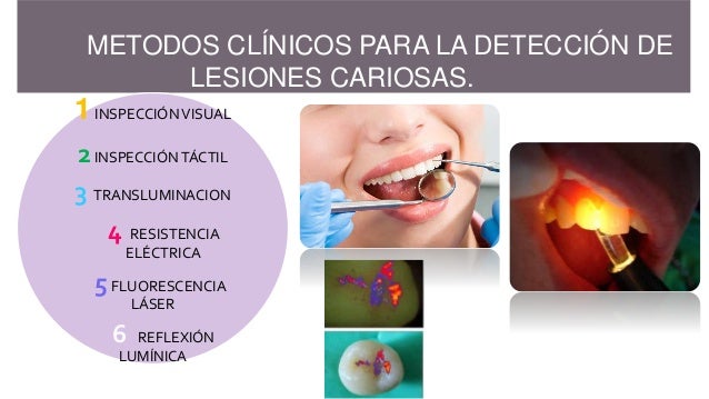 Operatoria -Deteccion de Caries Dental