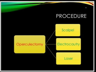 Operculitis , pericoronitis | PPTX