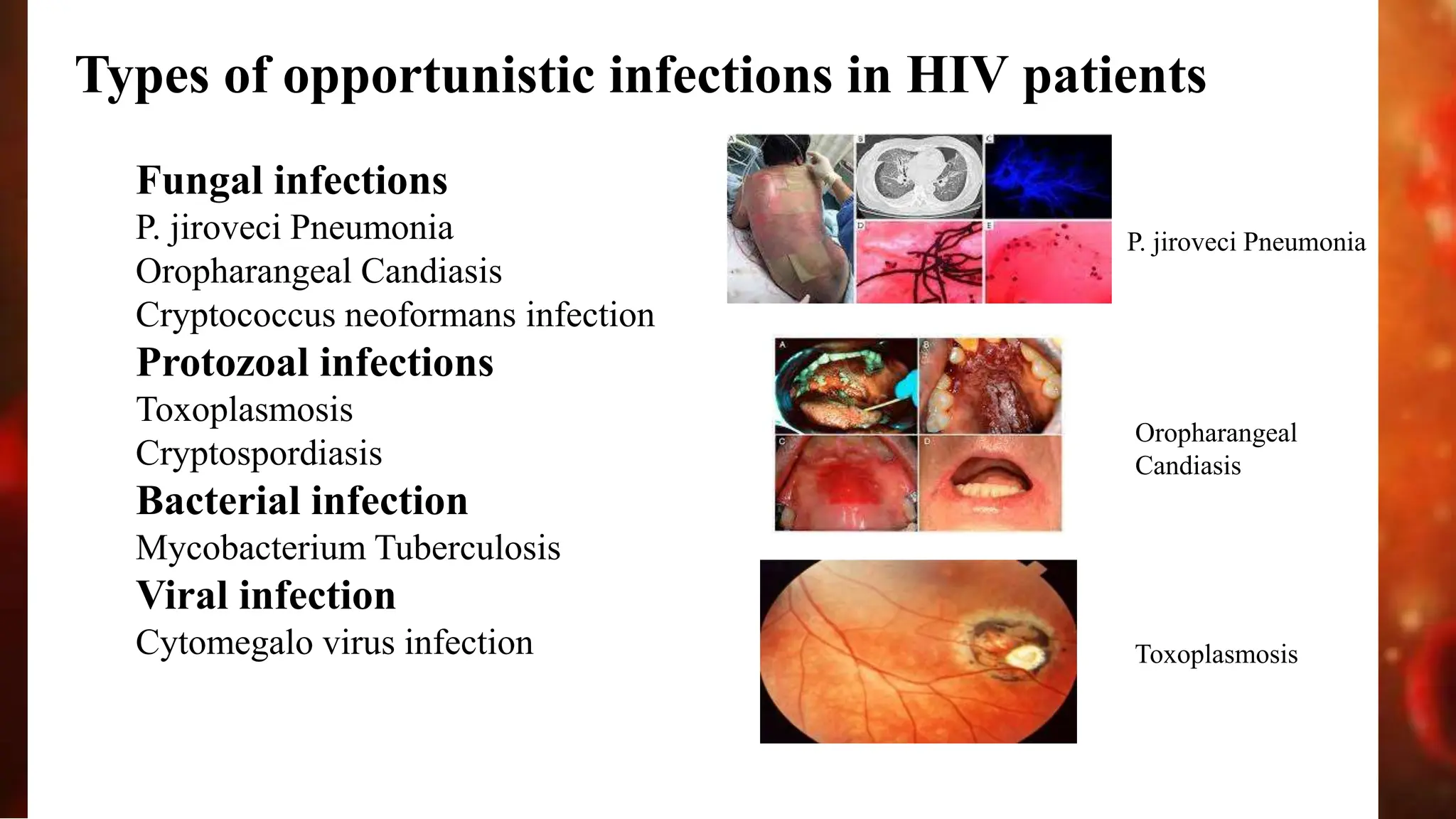 HIV AND OPPORTUNISTIC INFECTIONS IN HIV.pptx